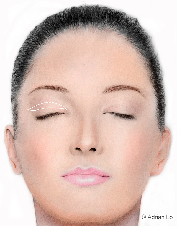 Upper Eyelid Surgery in Philadelphia, PA - Dr. Adrian Lo Plastic Surgery