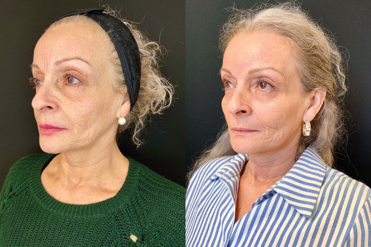 Forever Young BBL® and BBL HERO™ in Philadelphia and New Jersey ...