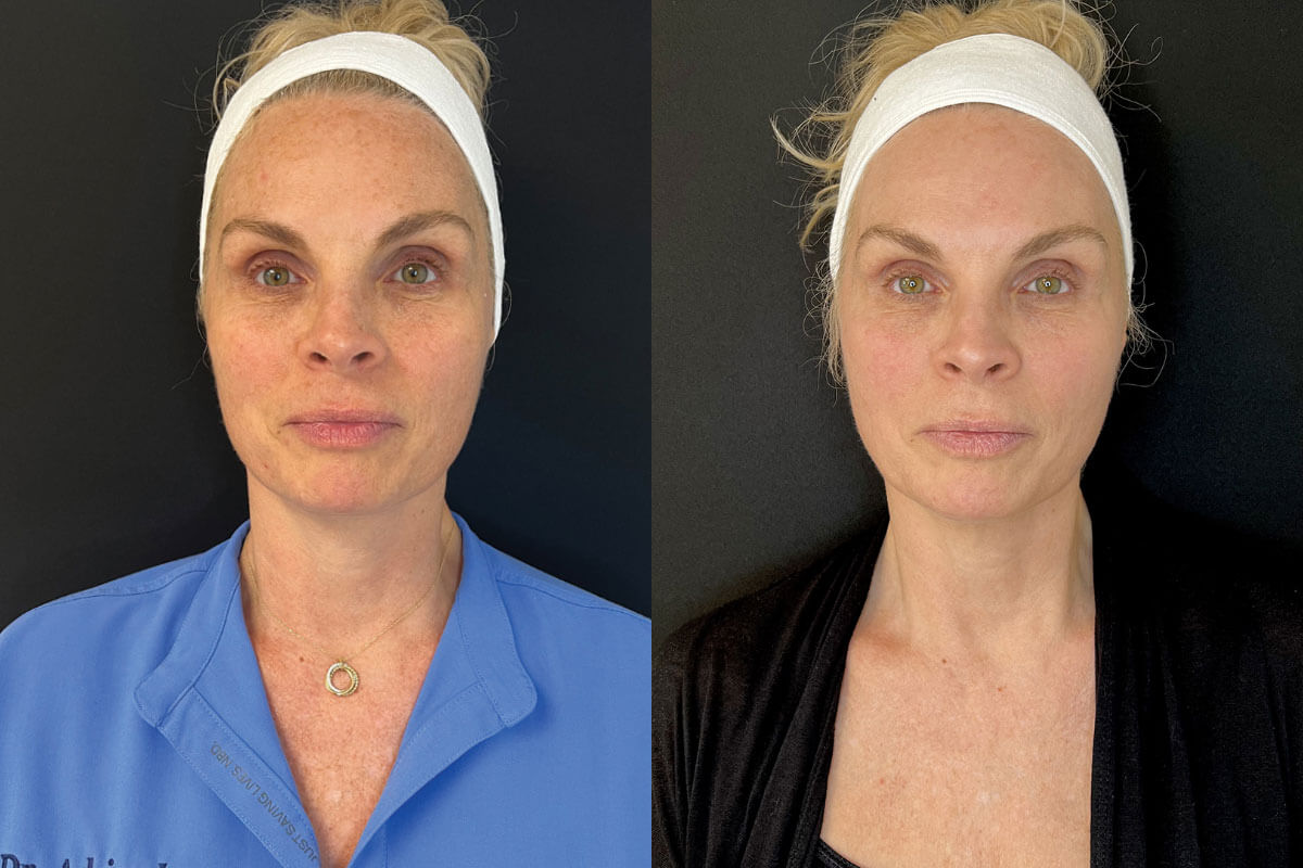 Forever Young BBL® and BBL HERO™ in Philadelphia and New Jersey ...