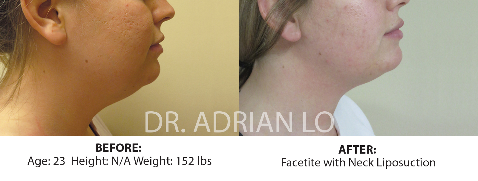 What to Expect in a Facetite Procedure - Philadelphia, PA - Dr. Adrian Lo Plastic Surgery