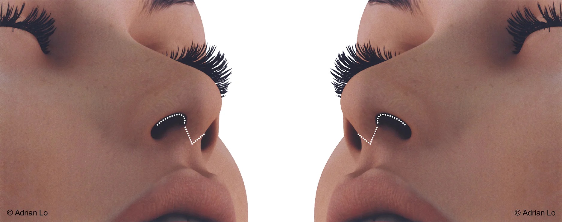 Open vs. Closed Rhinoplasty: What's the Difference? - Philadelphia, PA ...