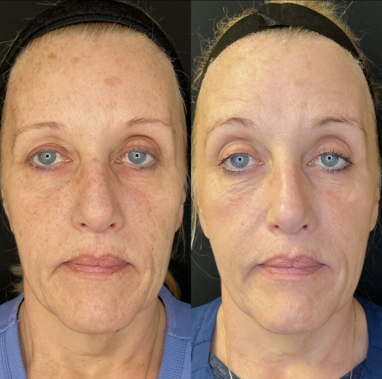 What the Sciton HALO Laser Can Do For Your Skin - Philadelphia, PA - Dr. Adrian Lo Plastic Surgery